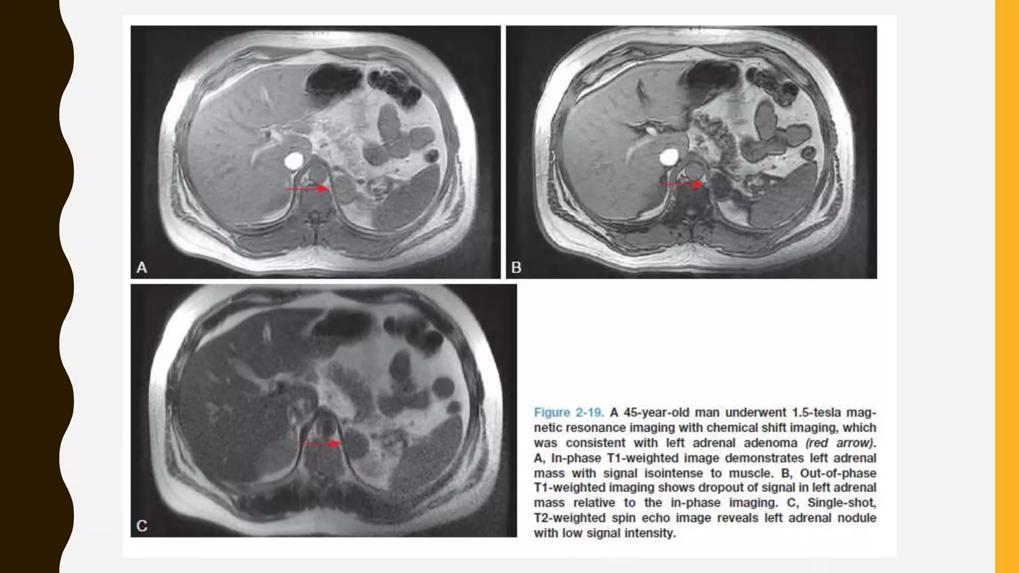 MRI basics | PPTX