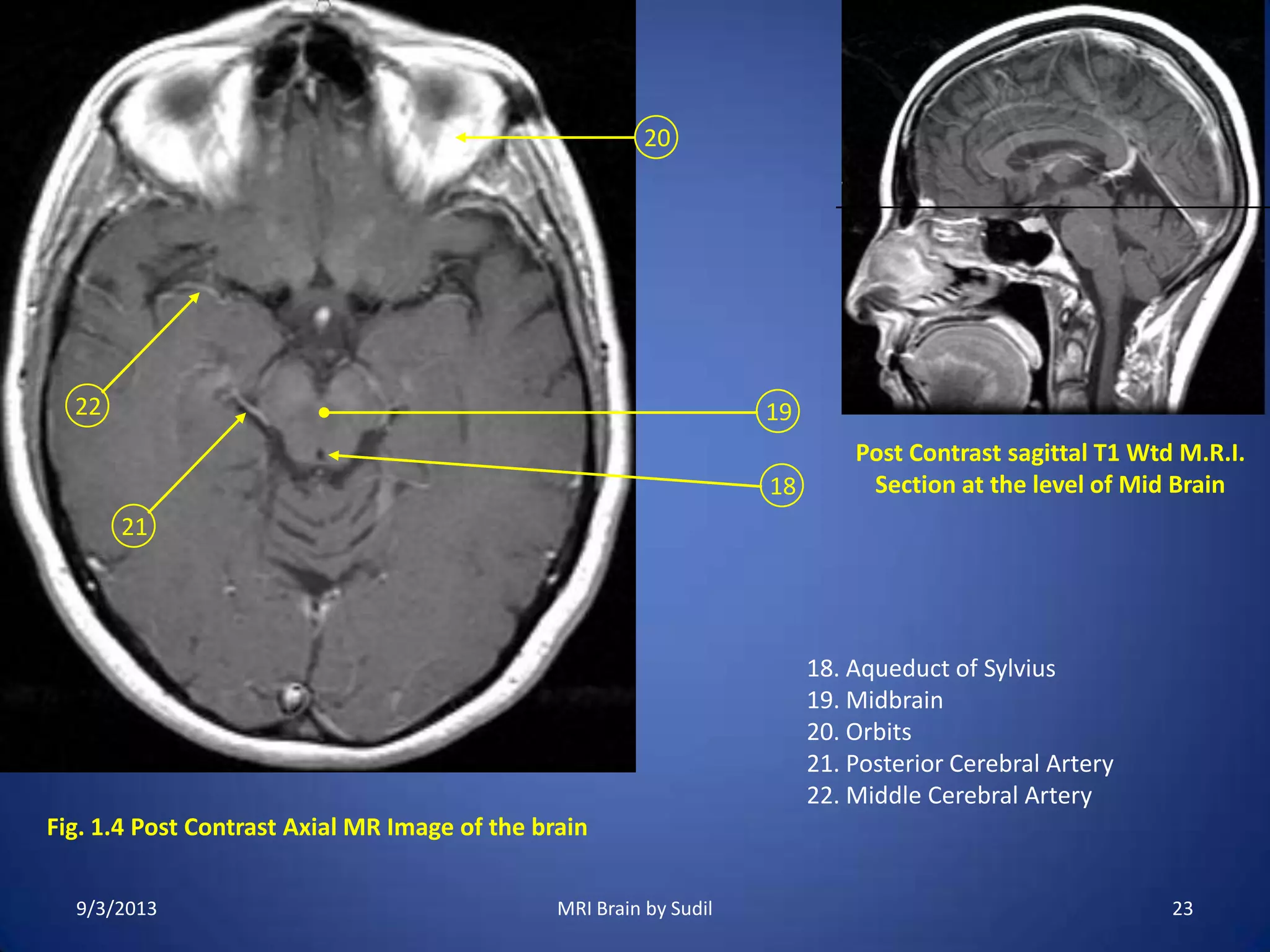 MRI Procedure of Brain | PPTX