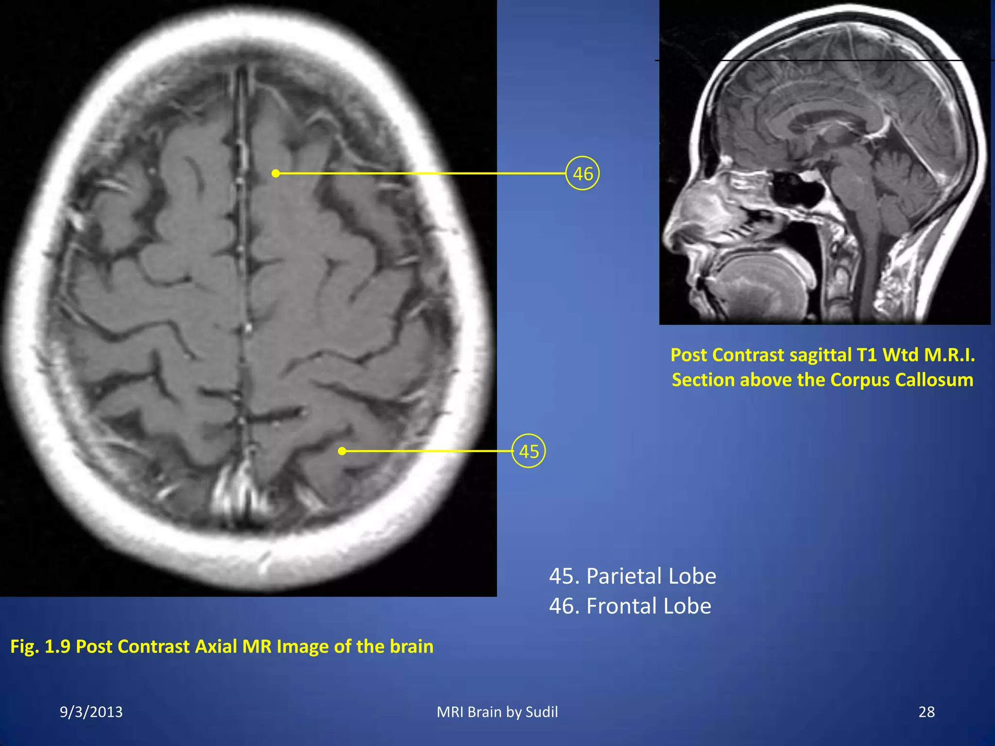 MRI Procedure of Brain | PPTX