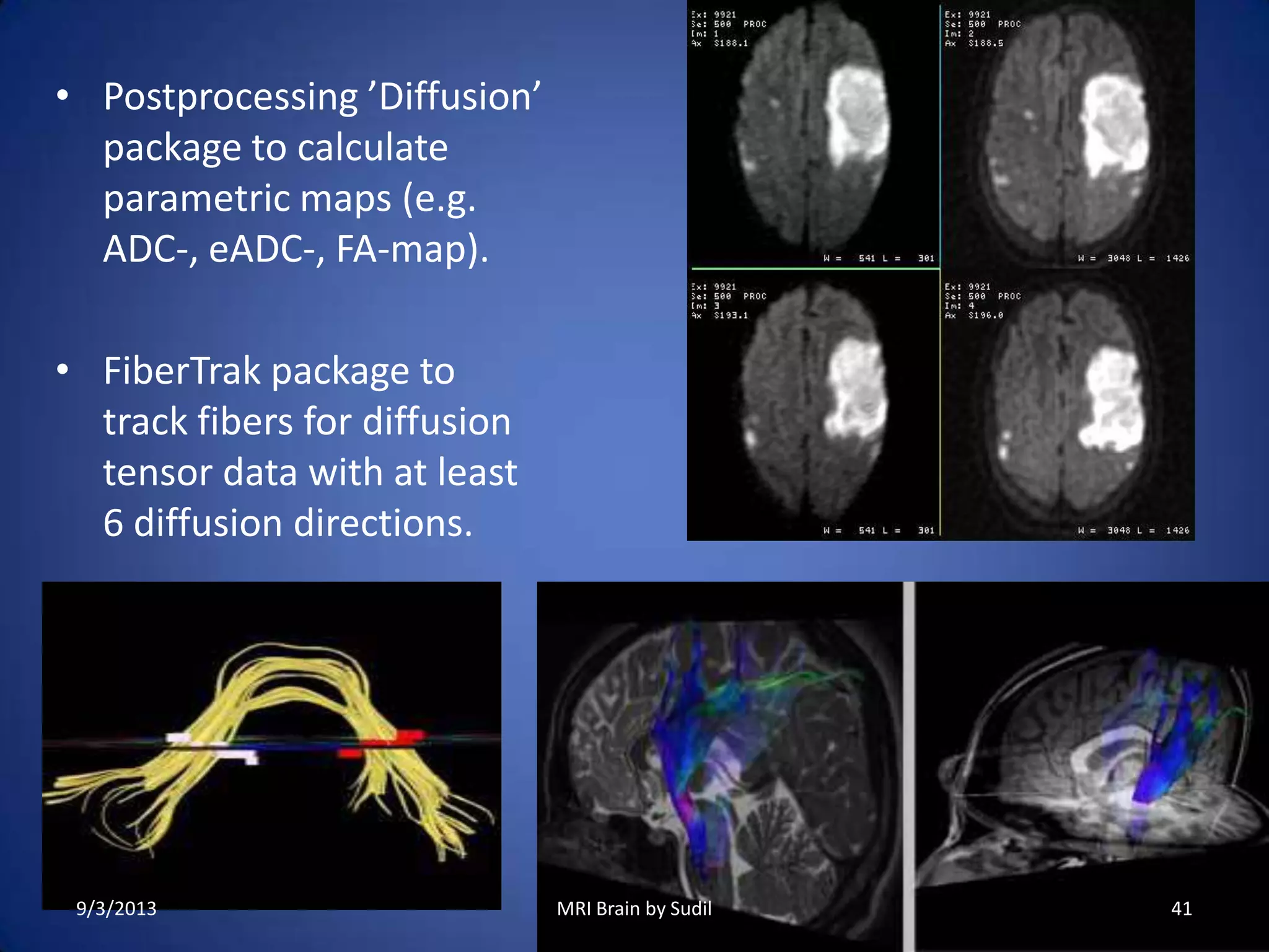 MRI Procedure of Brain | PPTX