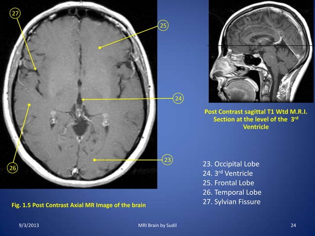 MRI Procedure of Brain | PPTX