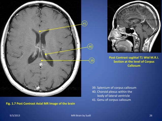 MRI Procedure of Brain | PPTX
