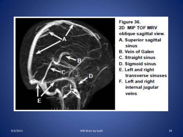 MRI Procedure of Brain | PPTX