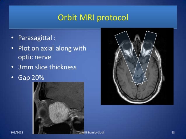 MRI Procedure of Brain