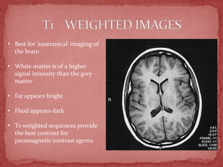 MRI Brain | PPT