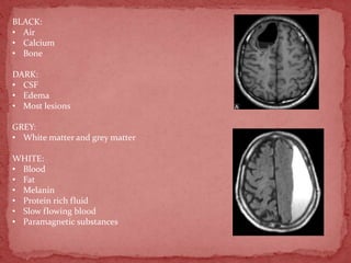 MRI Brain | PPTX