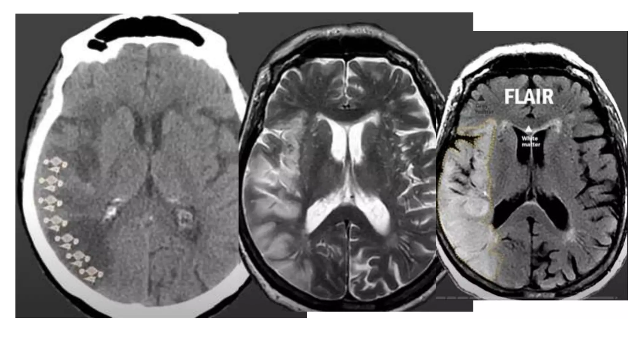 MRI PROCEDURE OF BRAIN | PPTX