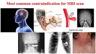 MRI PROCEDURE OF BRAIN | PPTX