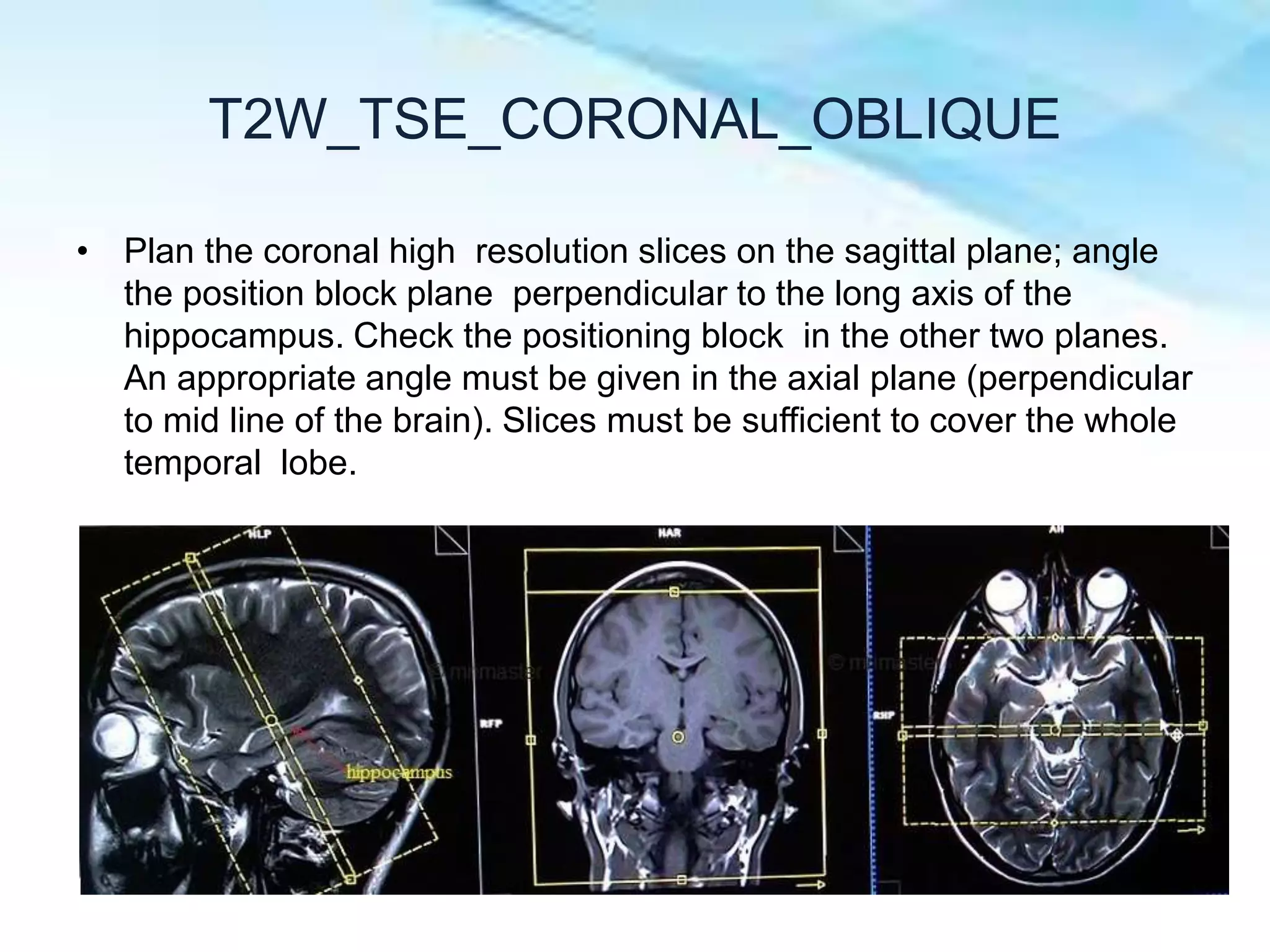 MRI BRAIN(AIIMS DELHI).pptx