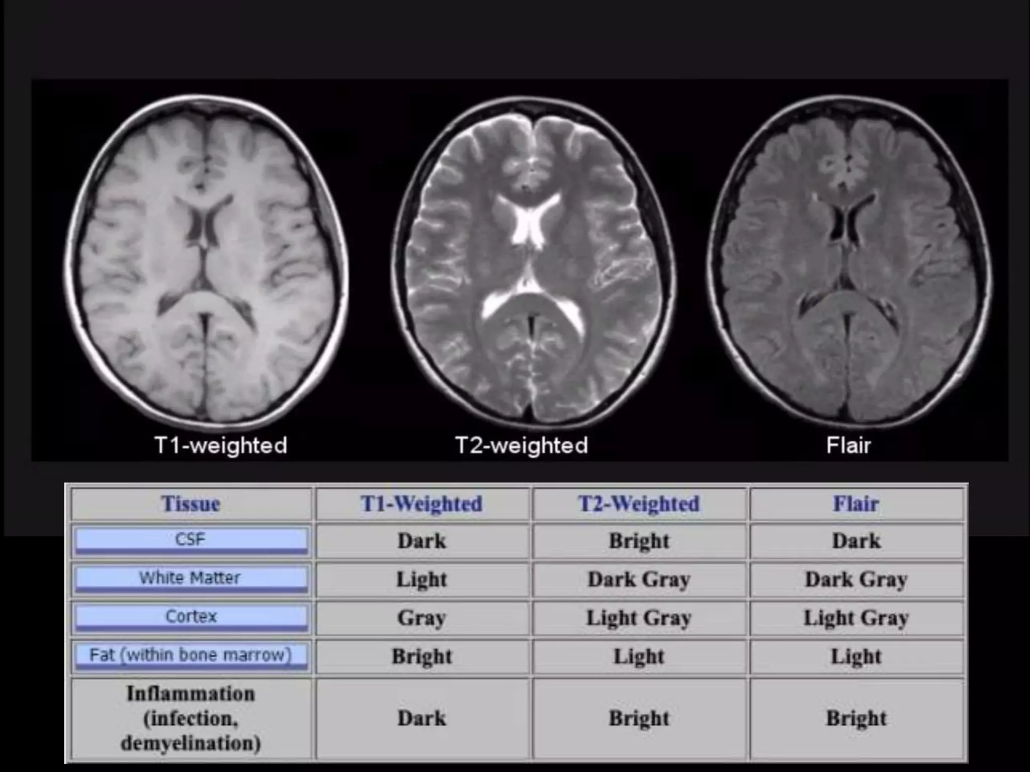 MRI BRAIN(AIIMS DELHI).pptx