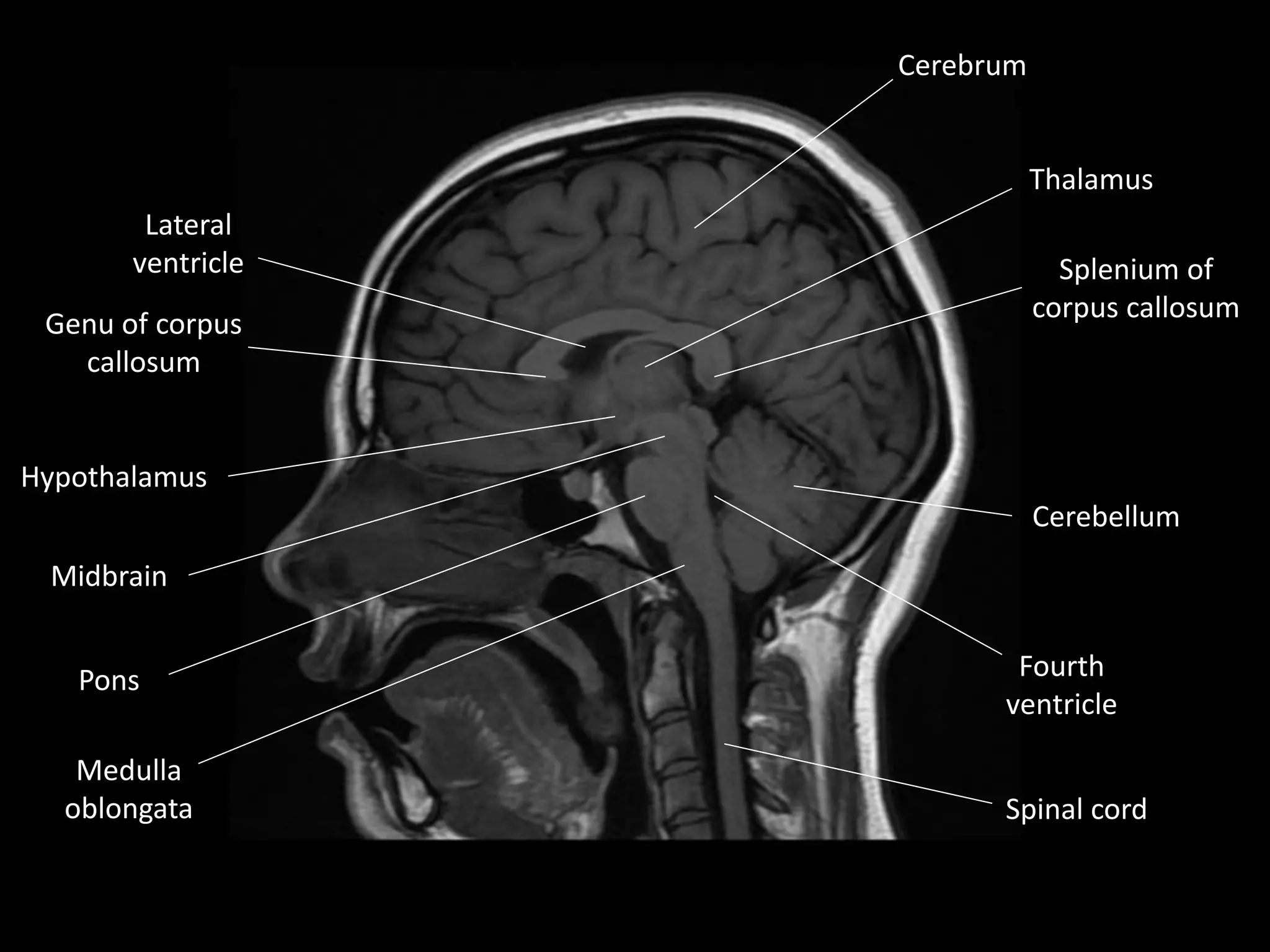 MRI BRAIN(AIIMS DELHI).pptx