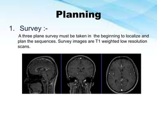 MRI BRAIN(AIIMS DELHI).pptx
