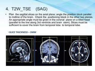 MRI BRAIN(AIIMS DELHI).pptx