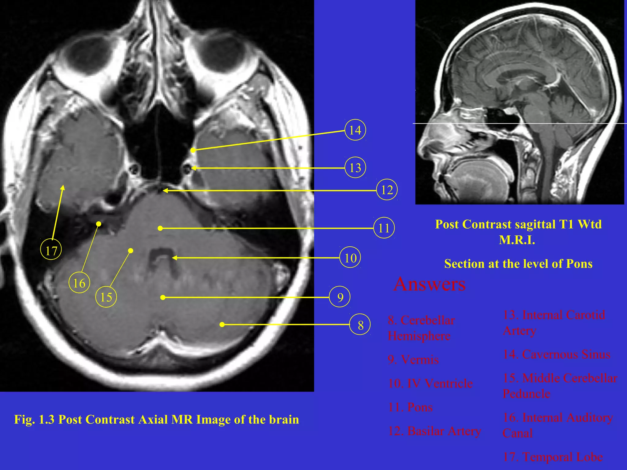 Mri brain anatomy Dr Muhammad Bin Zulfiqar | PPT