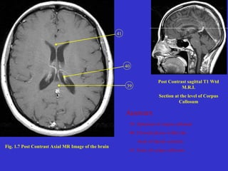 Axial Brain Anatomy