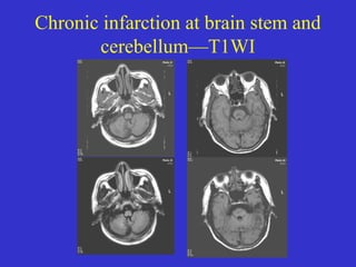 Brainstem Anatomy Mri