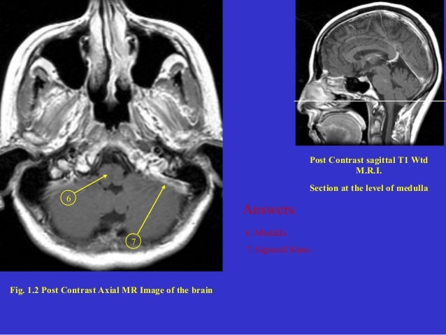 Brain Mri Medulla