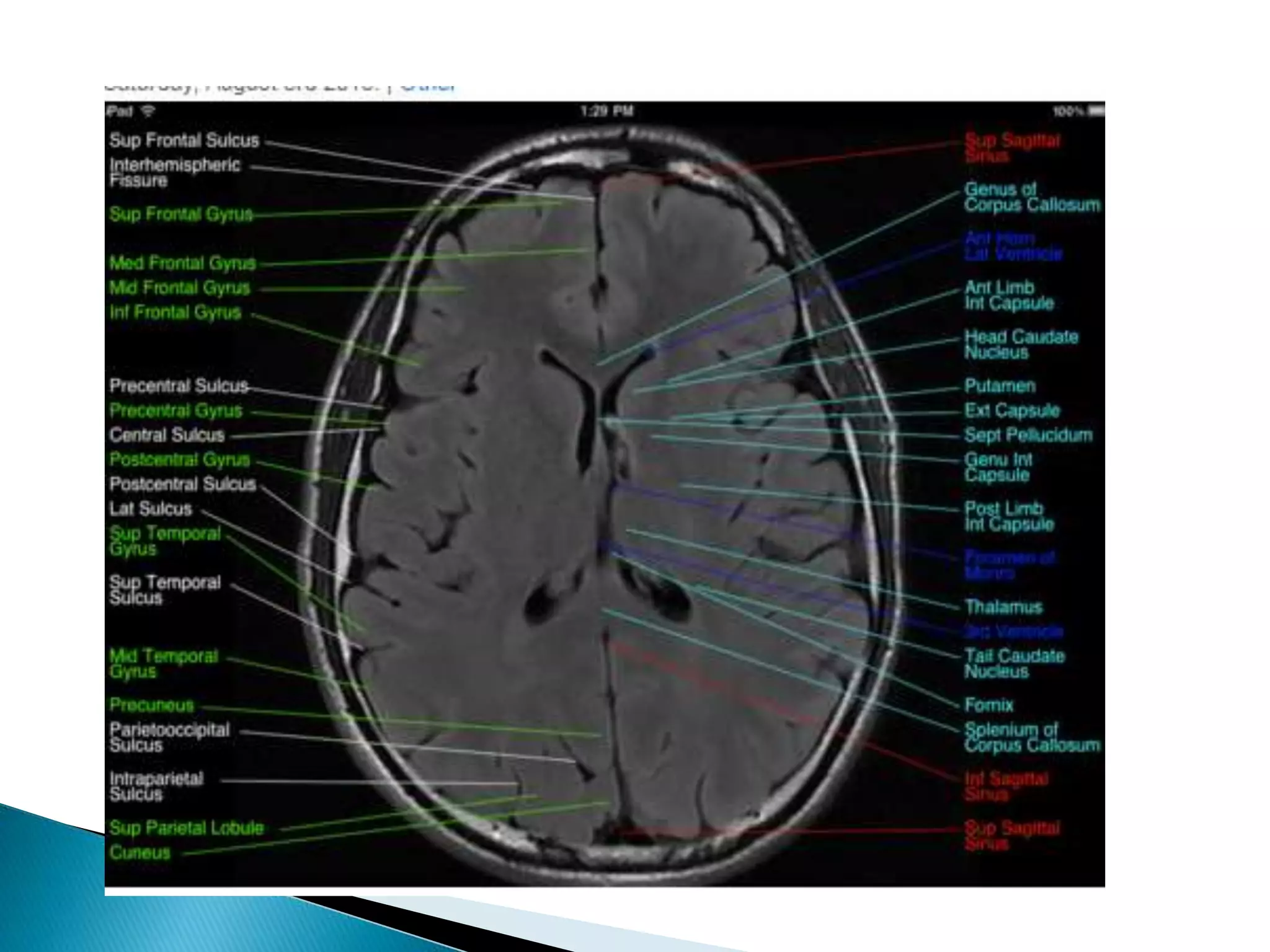 Mri brain imaging | PPTX | Brain and Nervous System Disorders | Diseases and Conditions