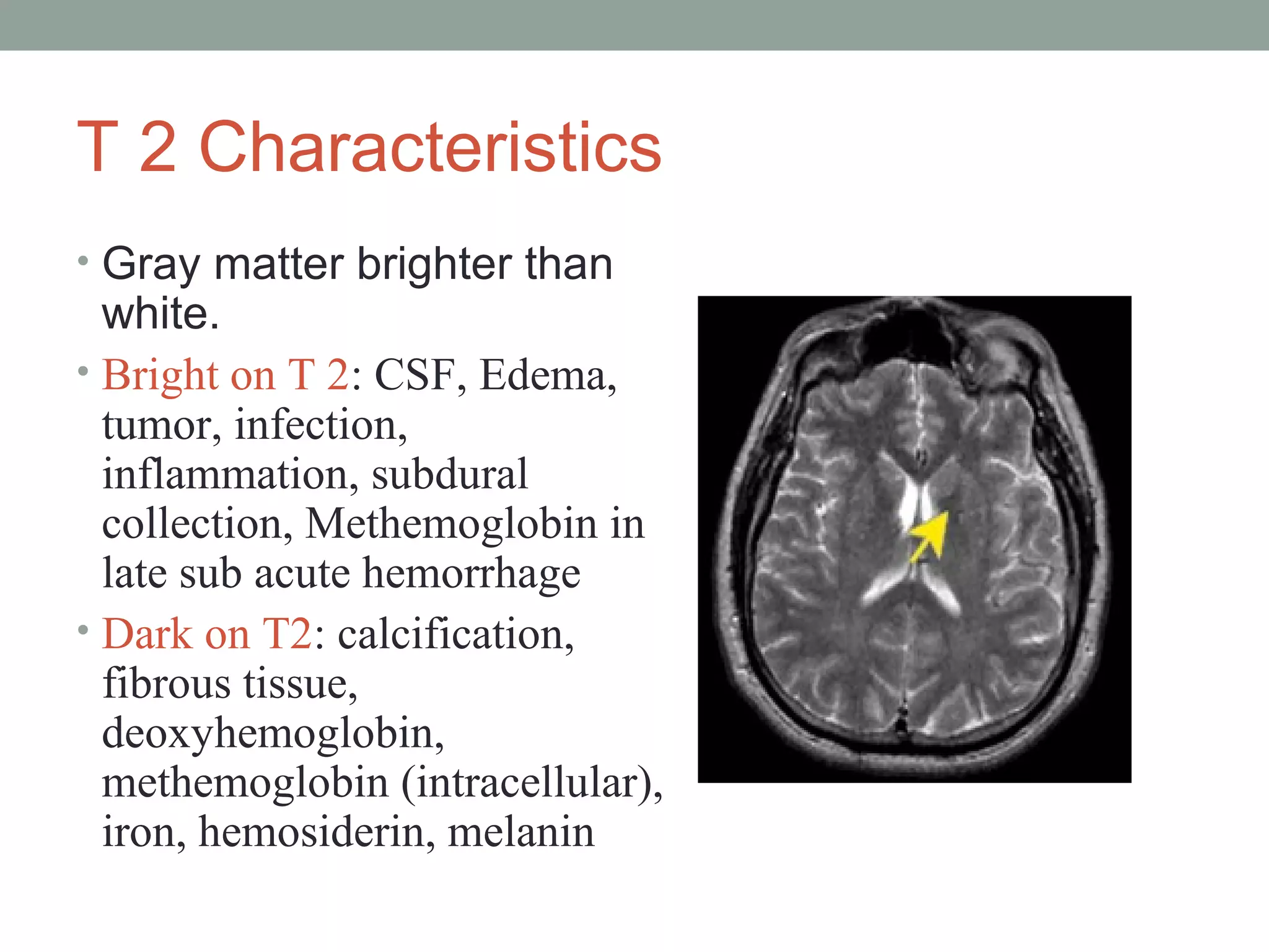 MRI brain; Basics and Radiological Anatomy | PPT