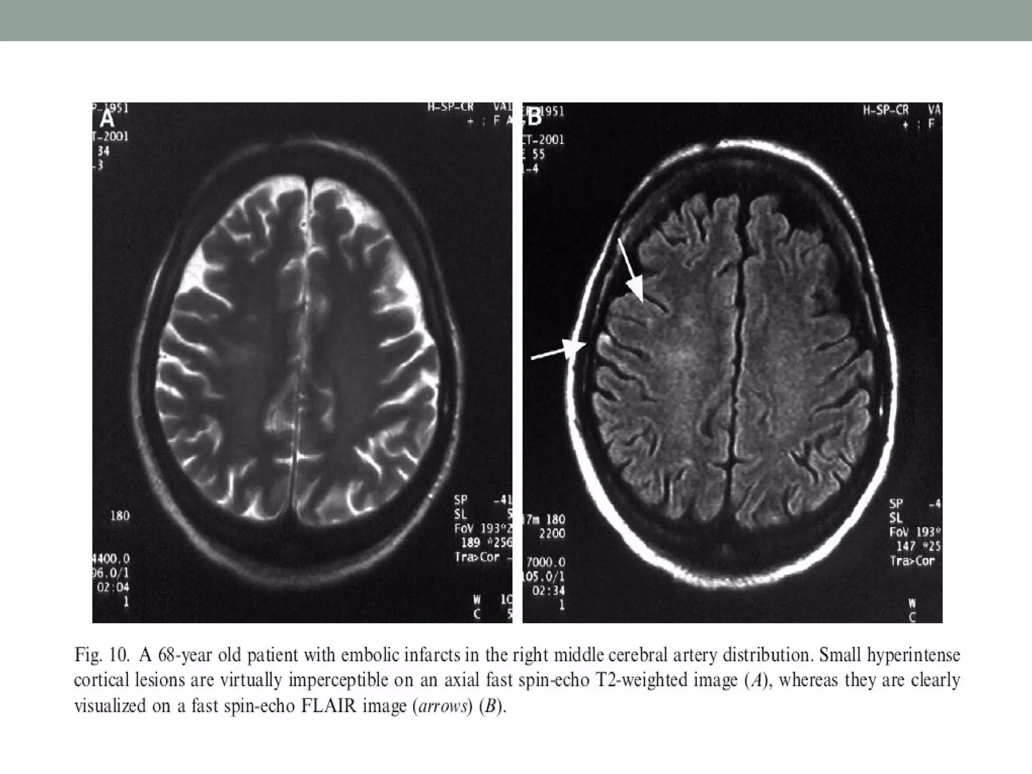 MRI brain; Basics and Radiological Anatomy | PPT | Physics | Science