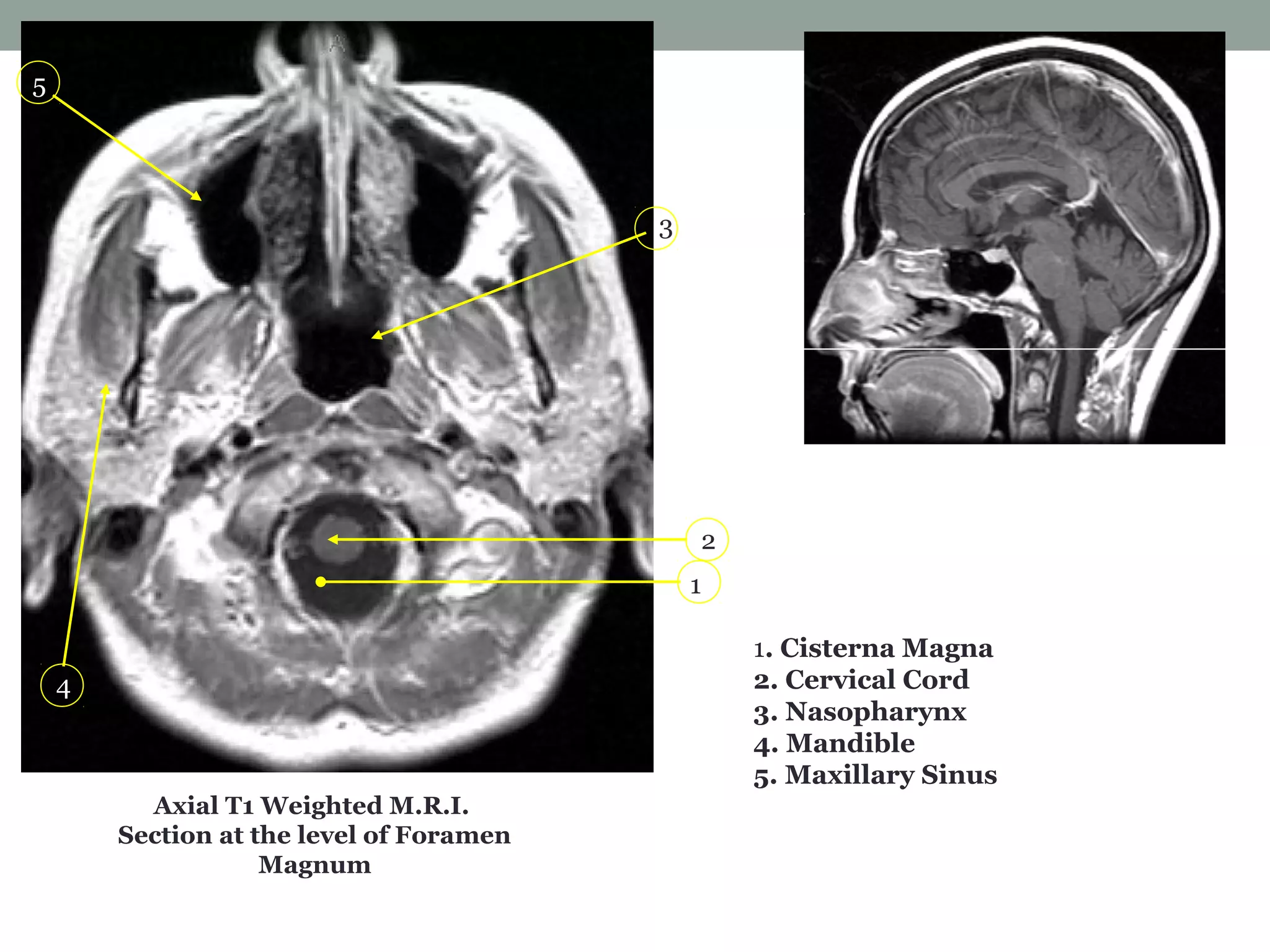 MRI brain; Basics and Radiological Anatomy | PPT
