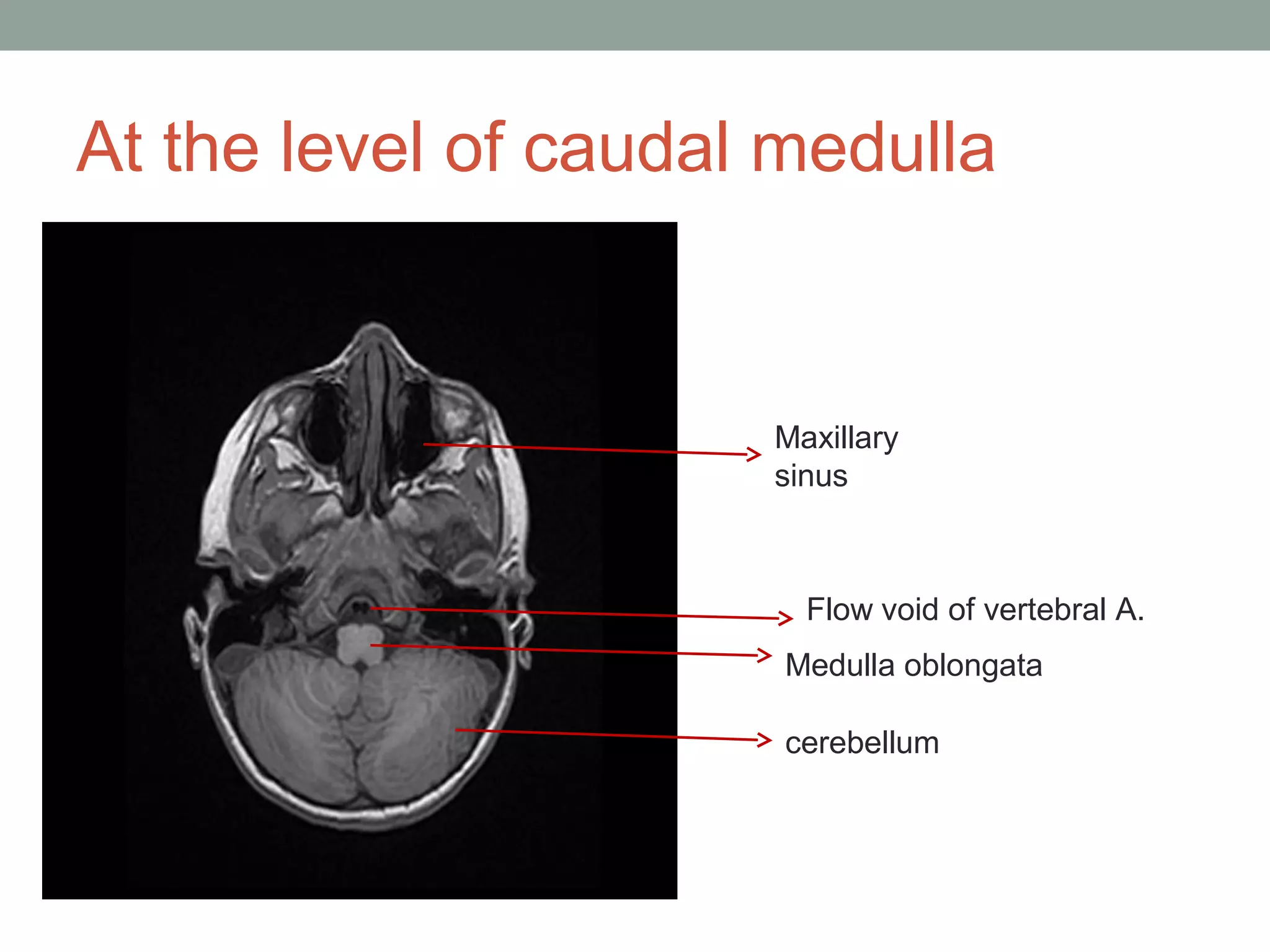 MRI brain; Basics and Radiological Anatomy | PPT