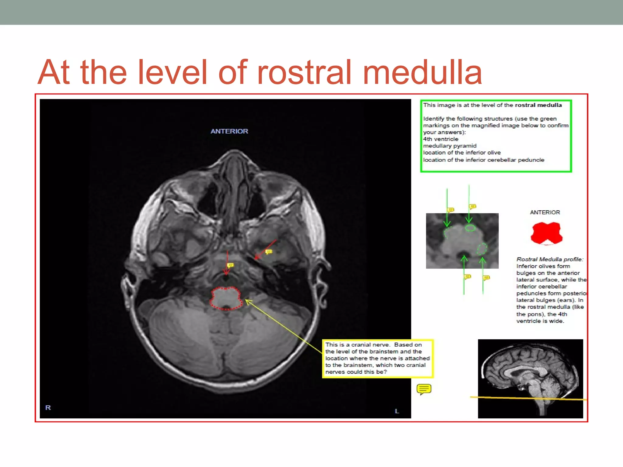 MRI brain; Basics and Radiological Anatomy | PPT