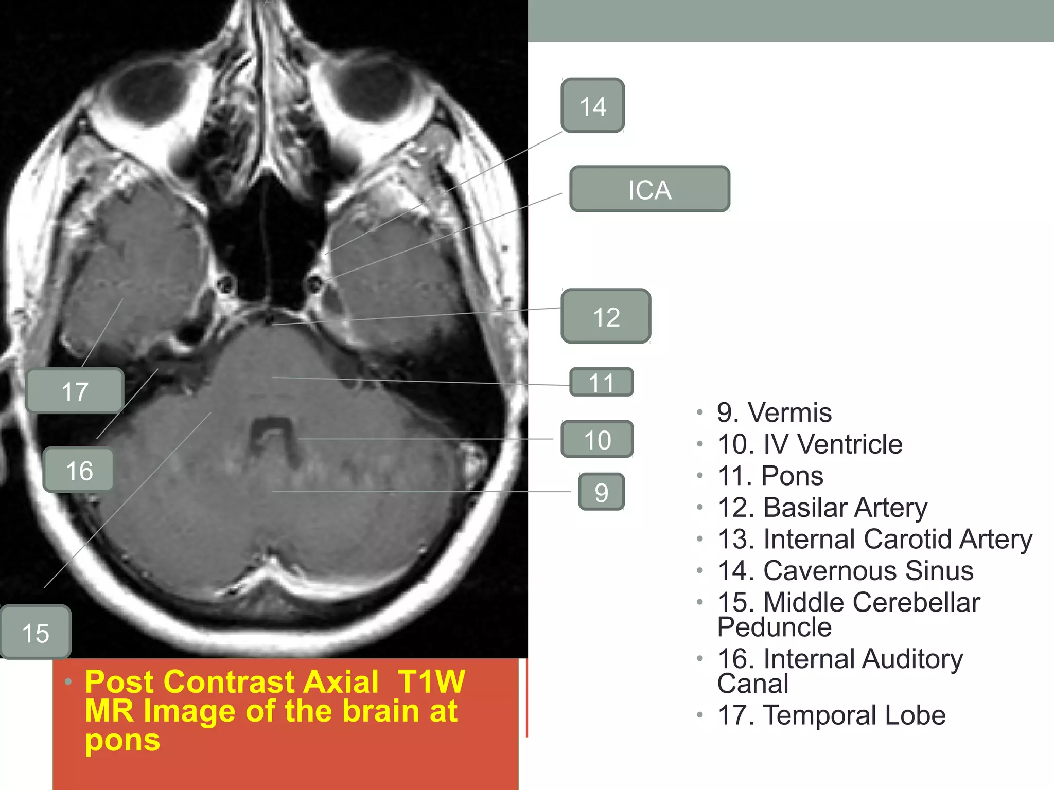 MRI brain; Basics and Radiological Anatomy | PPT | Physics | Science