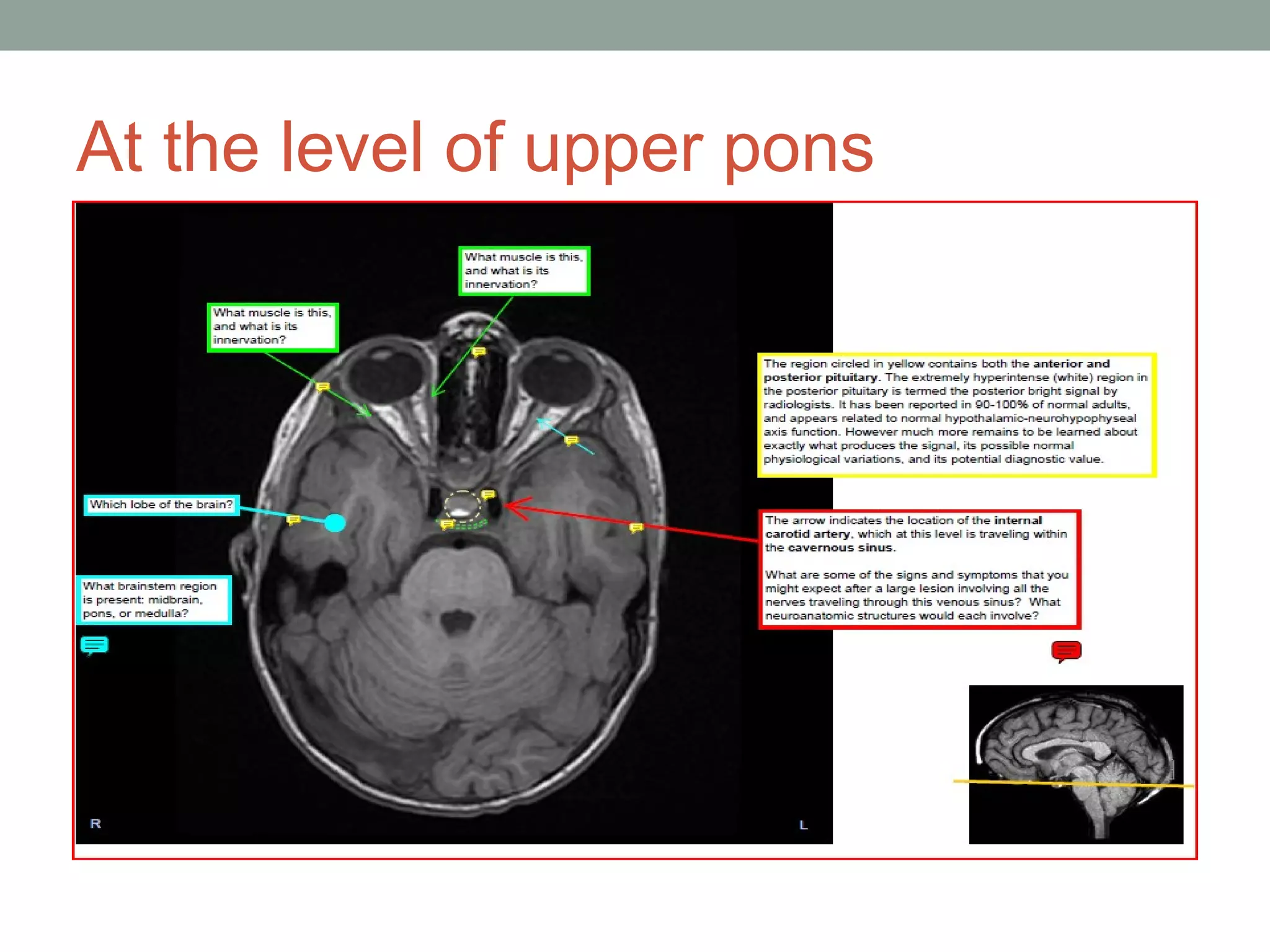 MRI brain; Basics and Radiological Anatomy | PPT