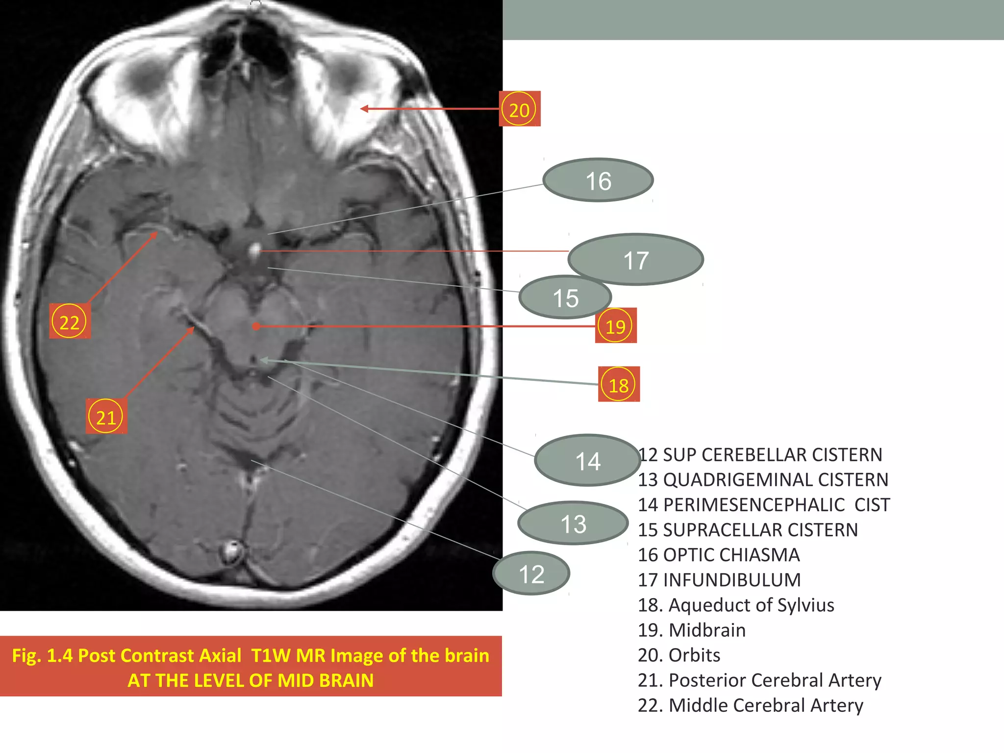 MRI brain; Basics and Radiological Anatomy | PPT