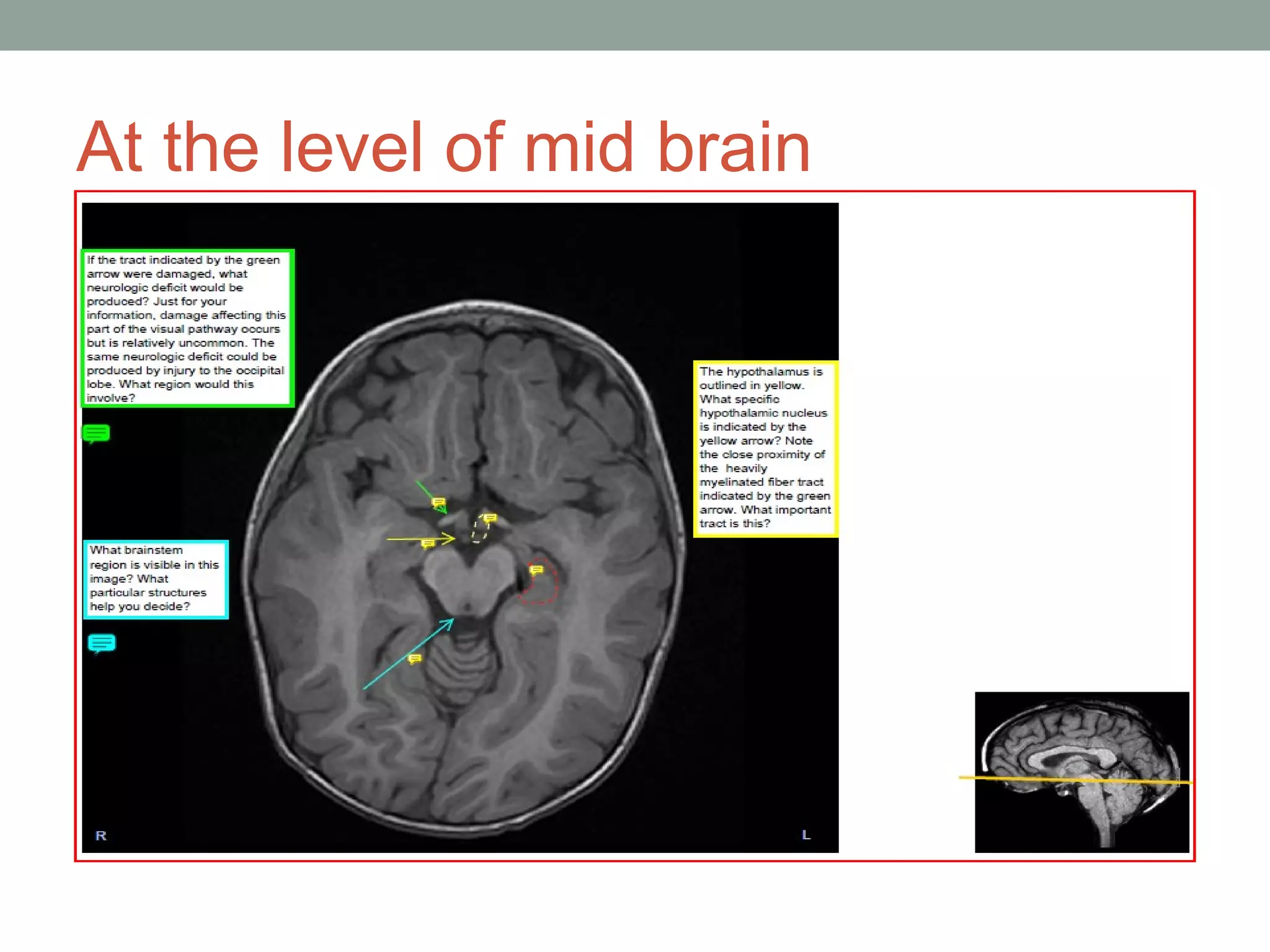 MRI brain; Basics and Radiological Anatomy | PPT | Physics | Science