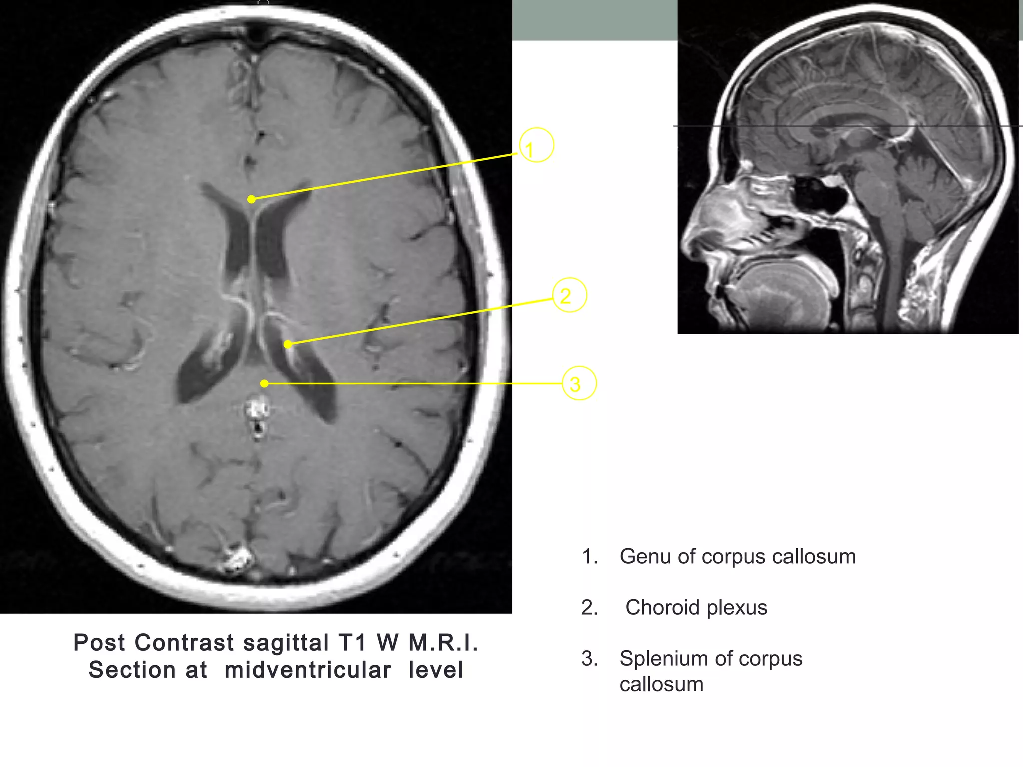 MRI brain; Basics and Radiological Anatomy | PPT