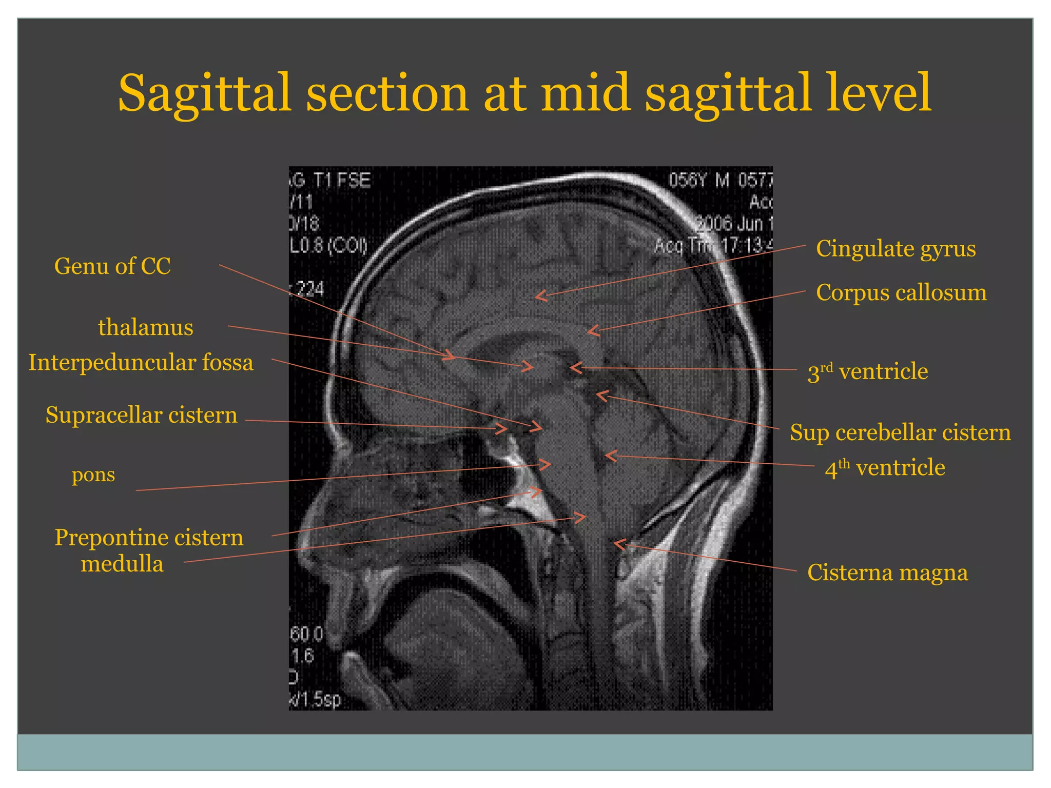MRI brain; Basics and Radiological Anatomy | PPT