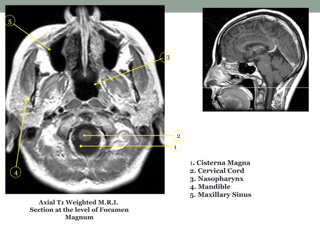 MRI brain; Basics and Radiological Anatomy | PPT | Physics | Science