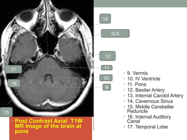 MRI brain; Basics and Radiological Anatomy | PPT | Physics | Science
