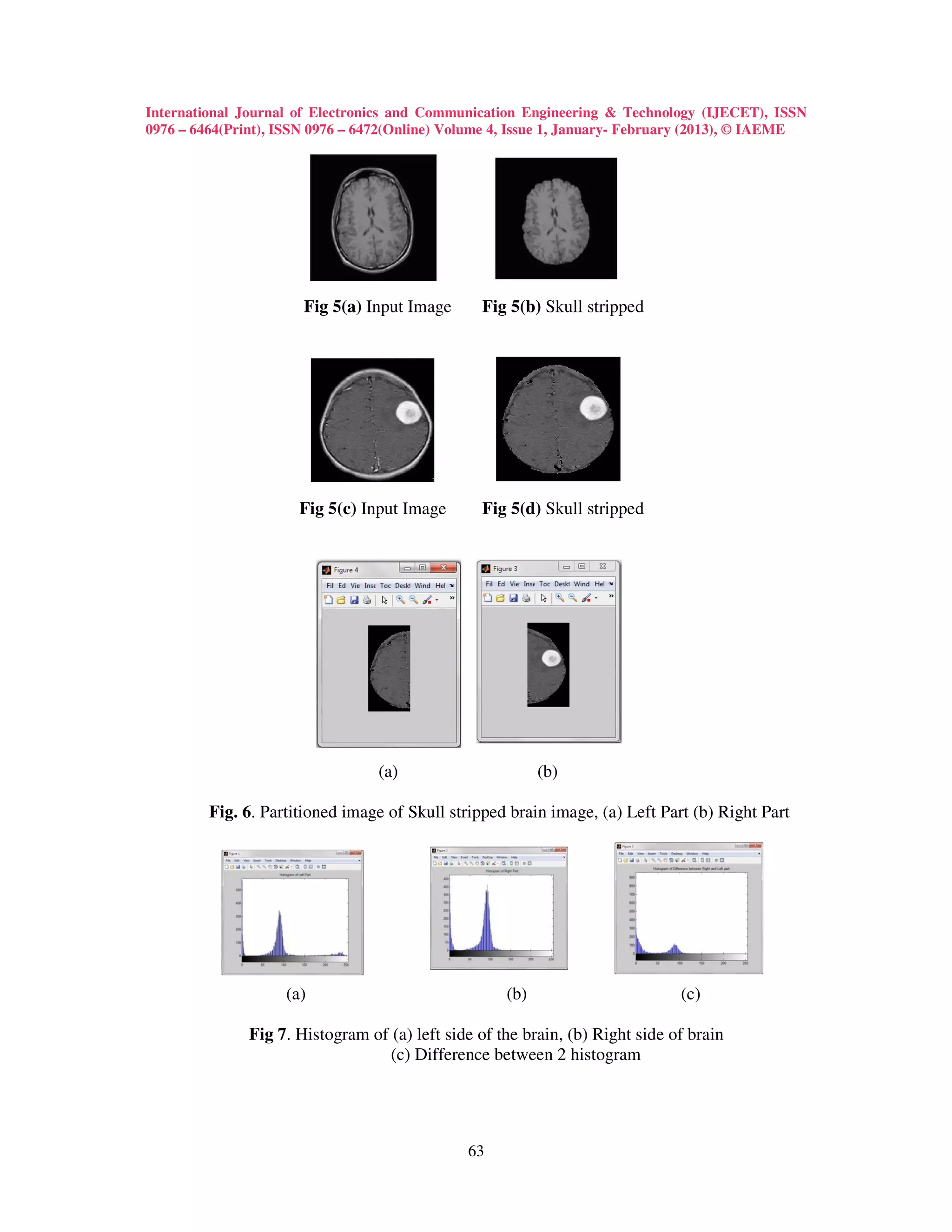 Mri brain tumour detection by histogram and segmentation | PDF