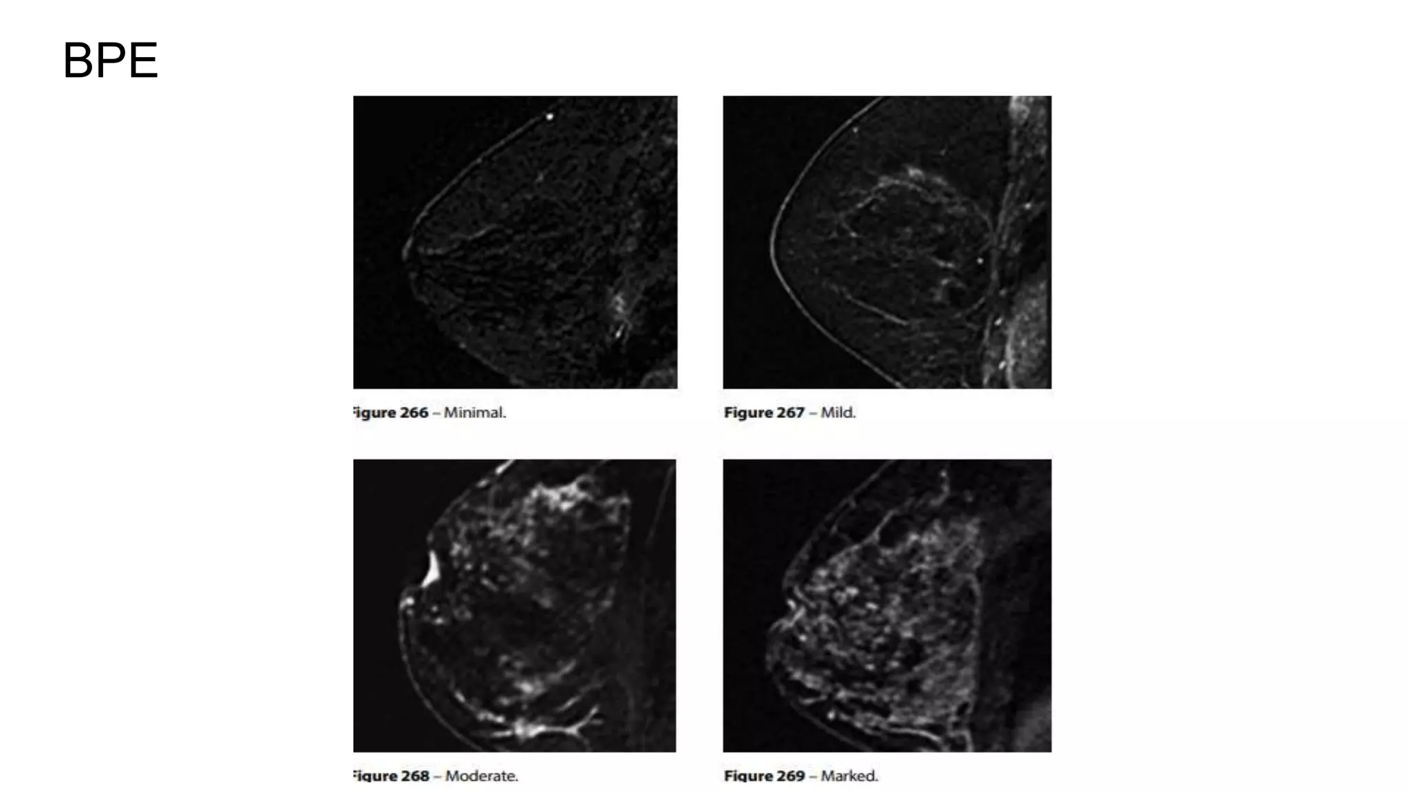 Mri breast (2) | PPTX