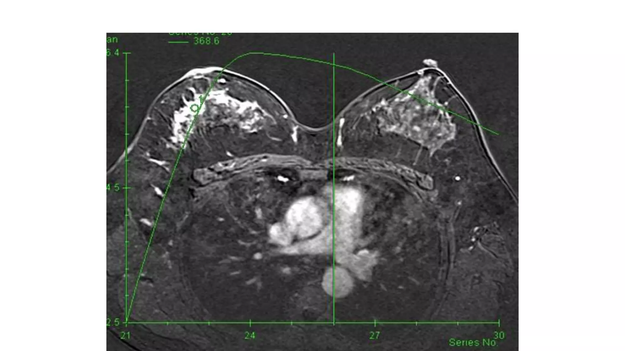 Mri breast (2) | PPTX