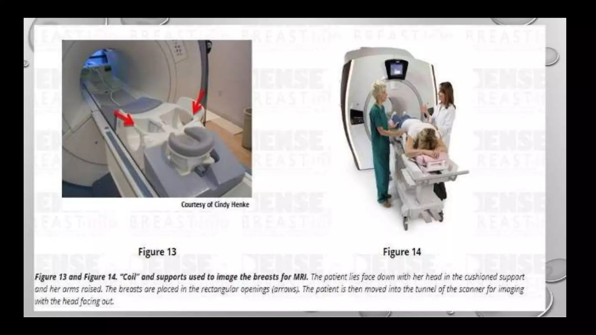 BREAST IMAGING MRI ppt DR ABHIJIT R SINGH | PPTX