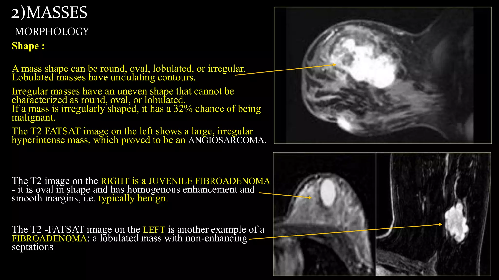 BREAST IMAGING MRI ppt DR ABHIJIT R SINGH | PPTX