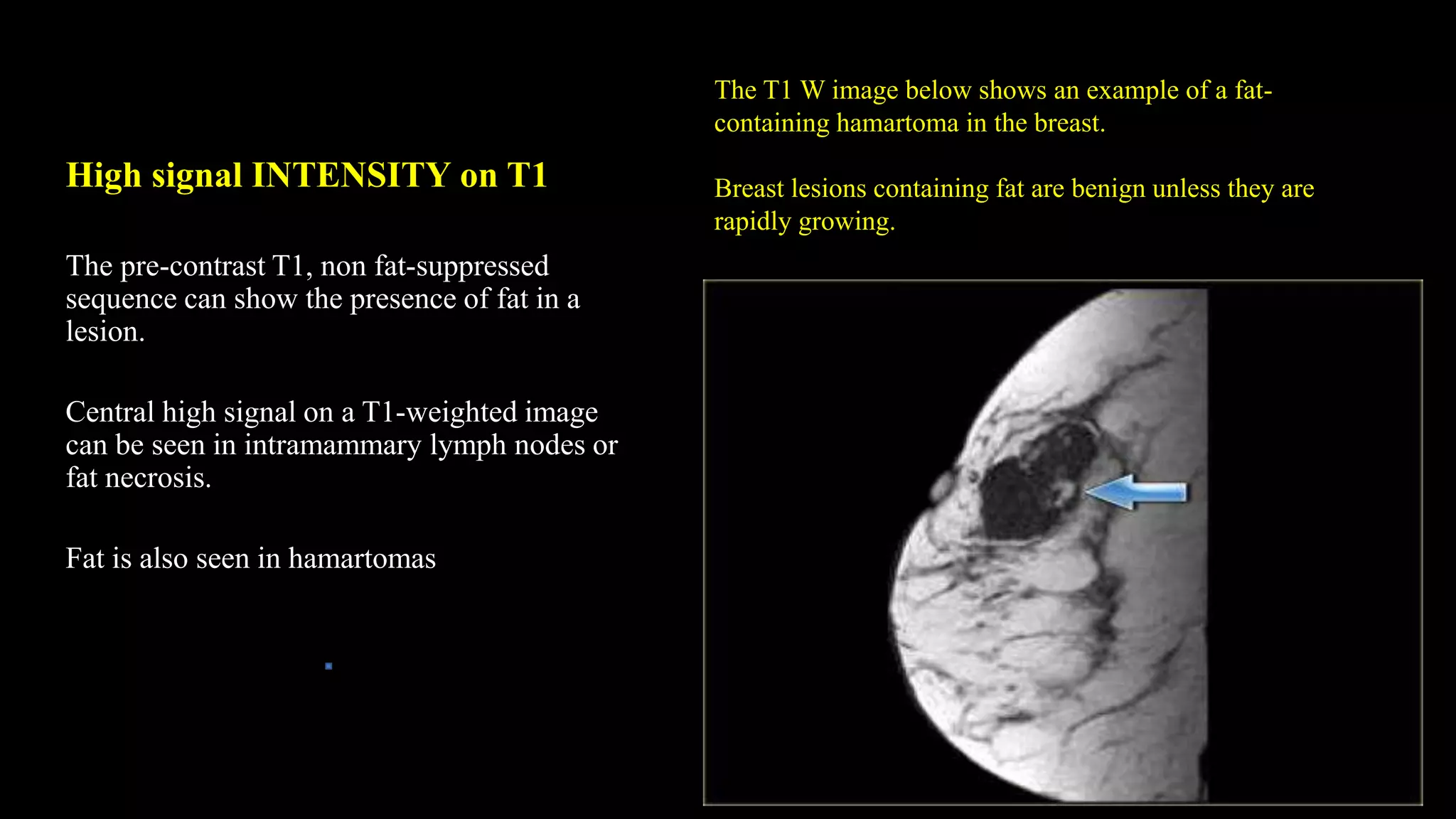 BREAST IMAGING MRI ppt DR ABHIJIT R SINGH | PPTX