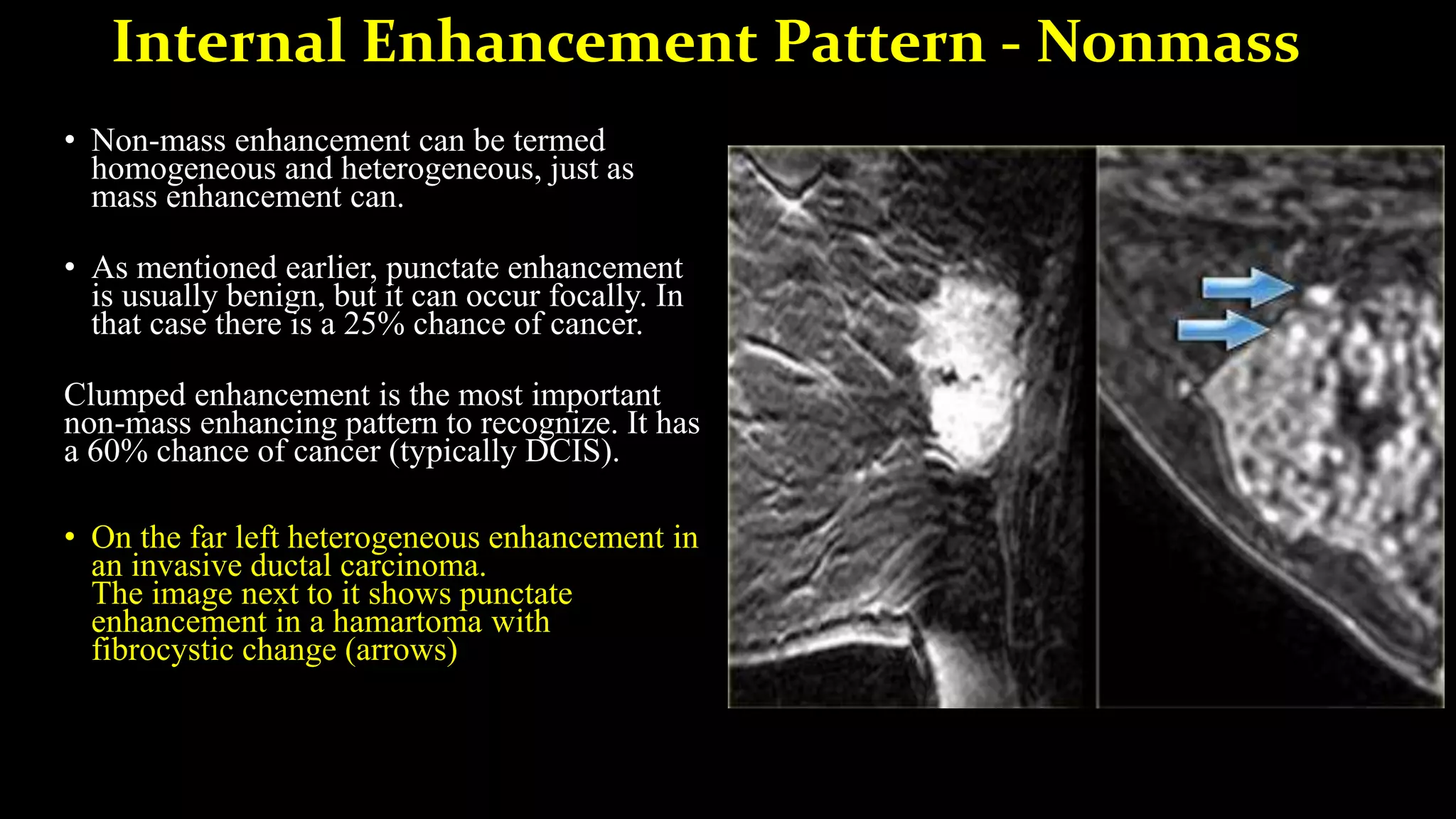 BREAST IMAGING MRI ppt DR ABHIJIT R SINGH | PPTX