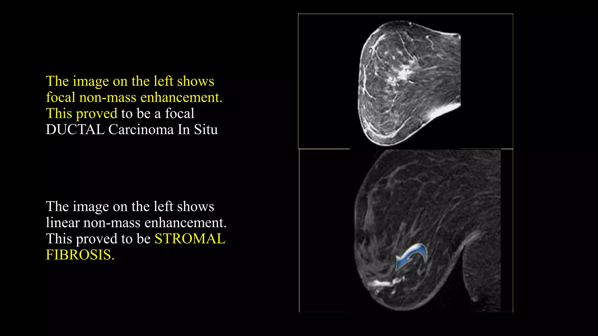 BREAST IMAGING MRI ppt DR ABHIJIT R SINGH | PPTX
