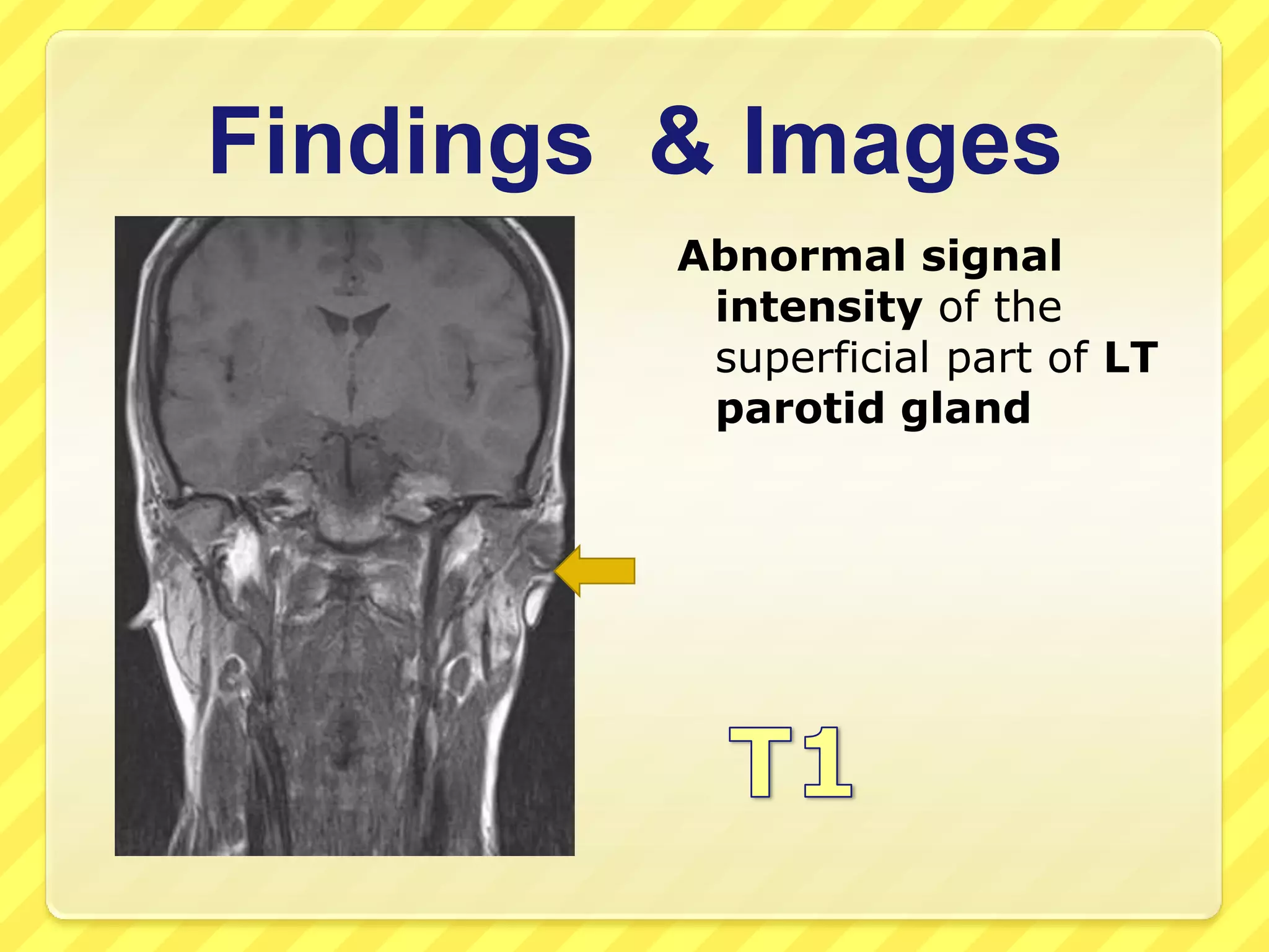 Mri case study- scleroderma | PPTX