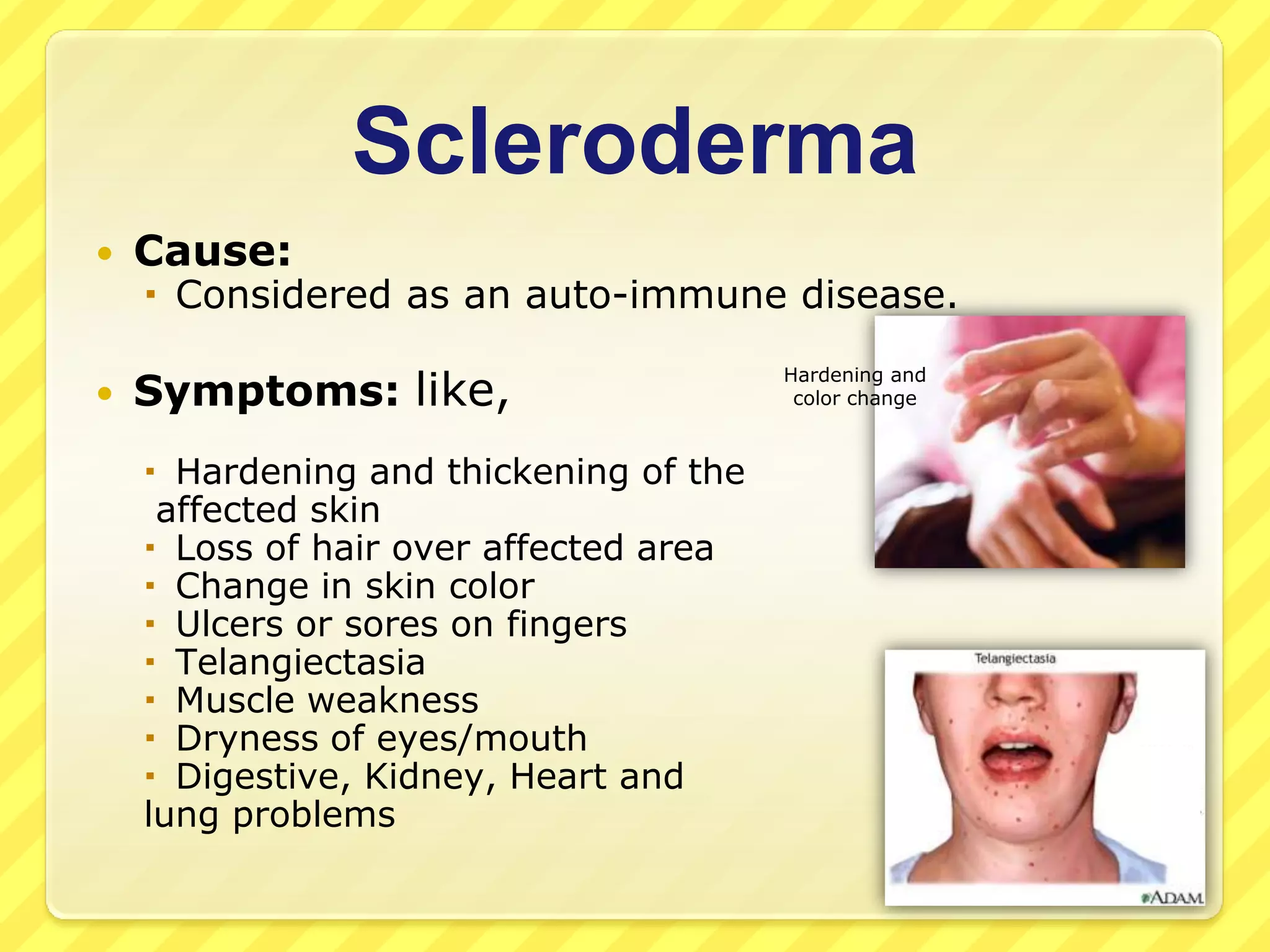 Mri case study- scleroderma | PPTX