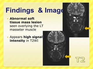 Mri case study- scleroderma | PPTX