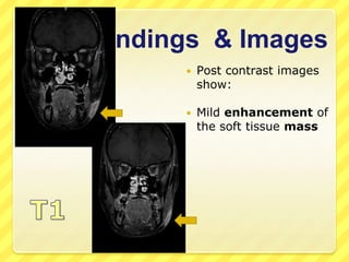 Mri case study- scleroderma | PPTX