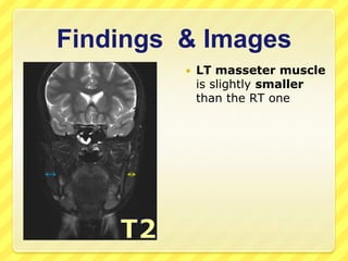 Mri case study- scleroderma | PPTX