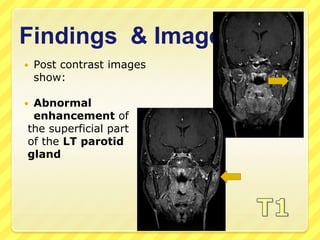 Mri case study- scleroderma | PPTX
