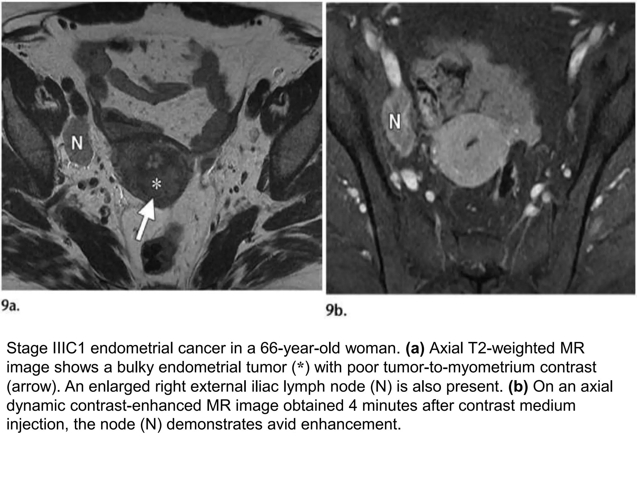 MRI carcinoma Uterus and Cervix | PPTX